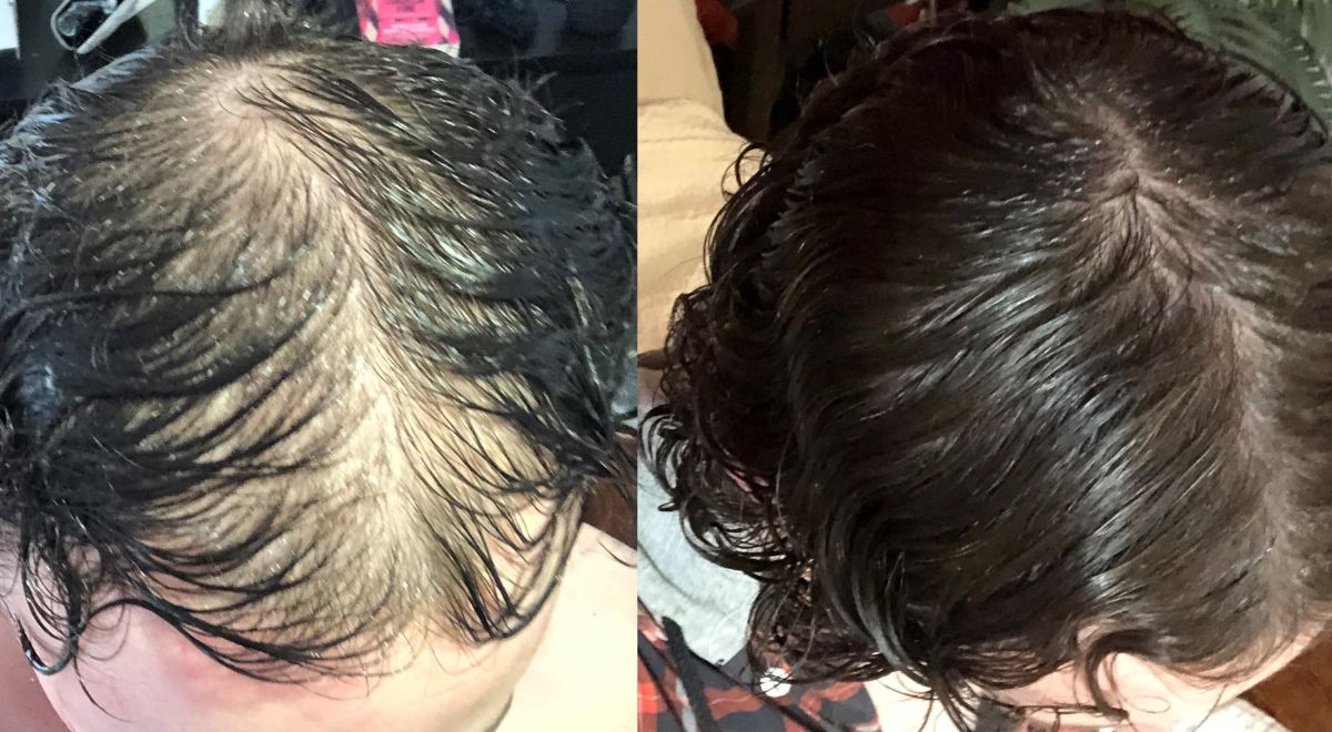 Haarausfall stoppen und Haare nachwachsen lassen mit diesen 5 ...