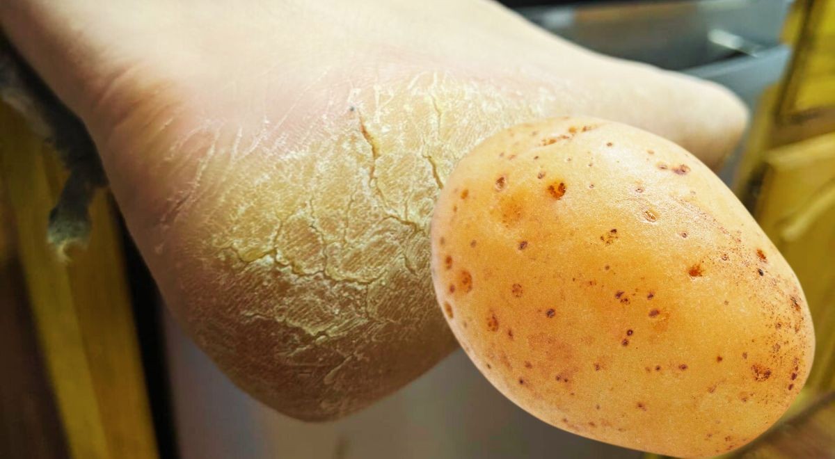 Cracked heels: from potatoes to other natural remedies, find out how to ...